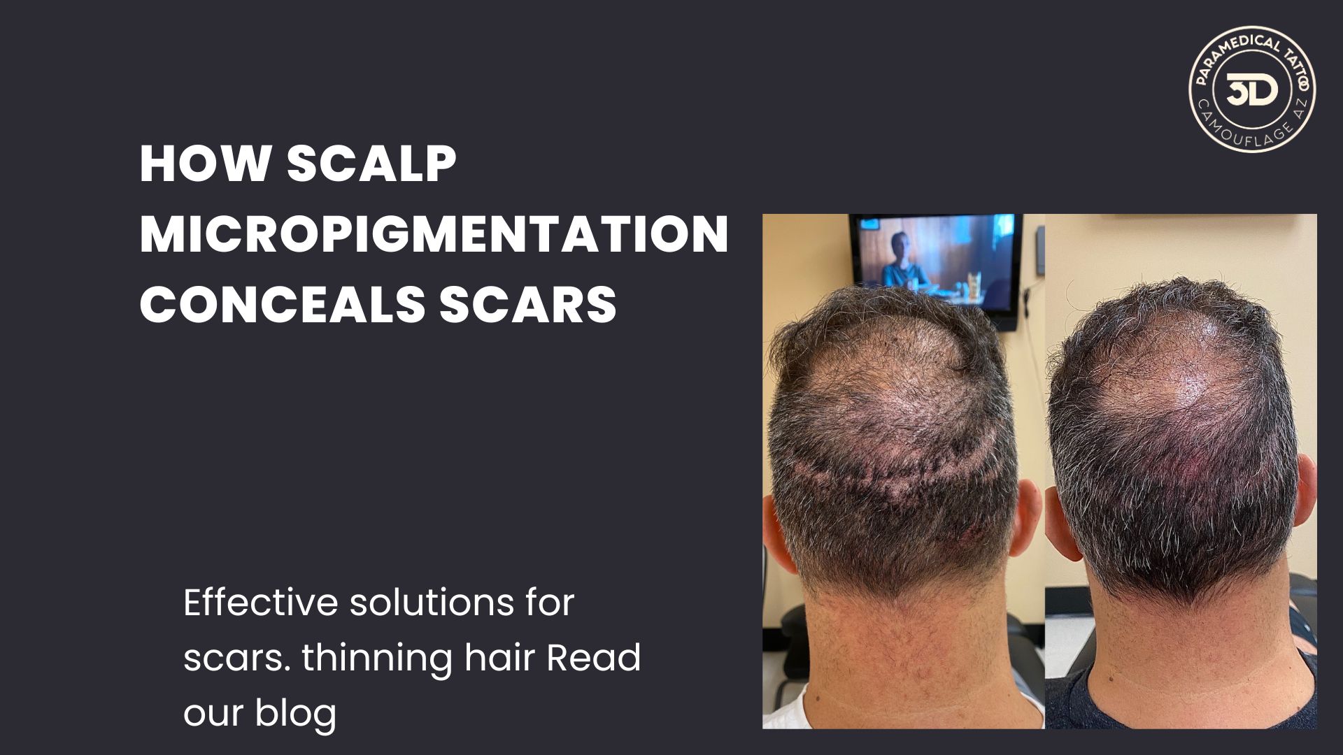 How Scalp Micropigmentation Conceals Scars - 3dcamouflageaz